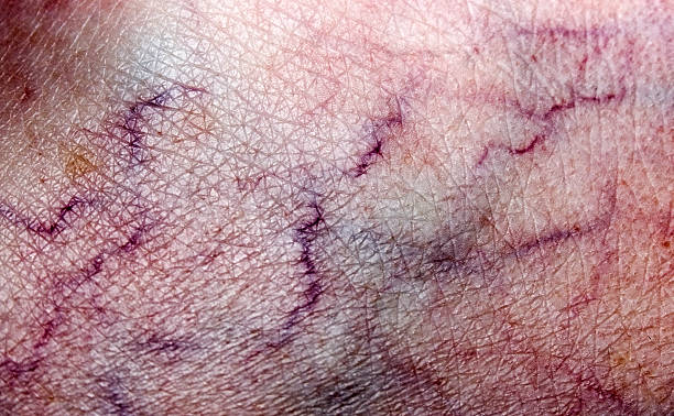 Os primeiros sintomas e sinais de alerta de varizes - Acrescentando